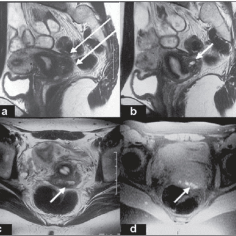 saco de douglas – Anatomia papel e caneta